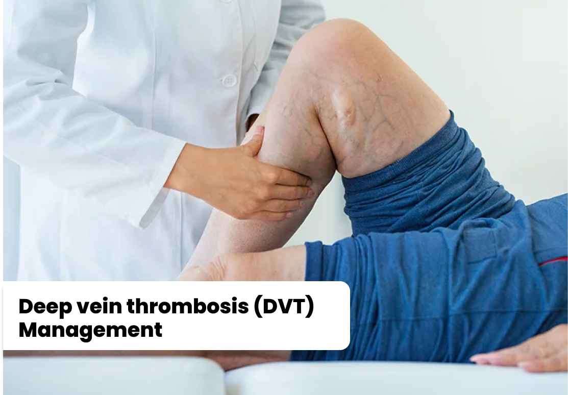 DVT Treatment: Medication, Surgery, and Home Remedies | DoctorsApp