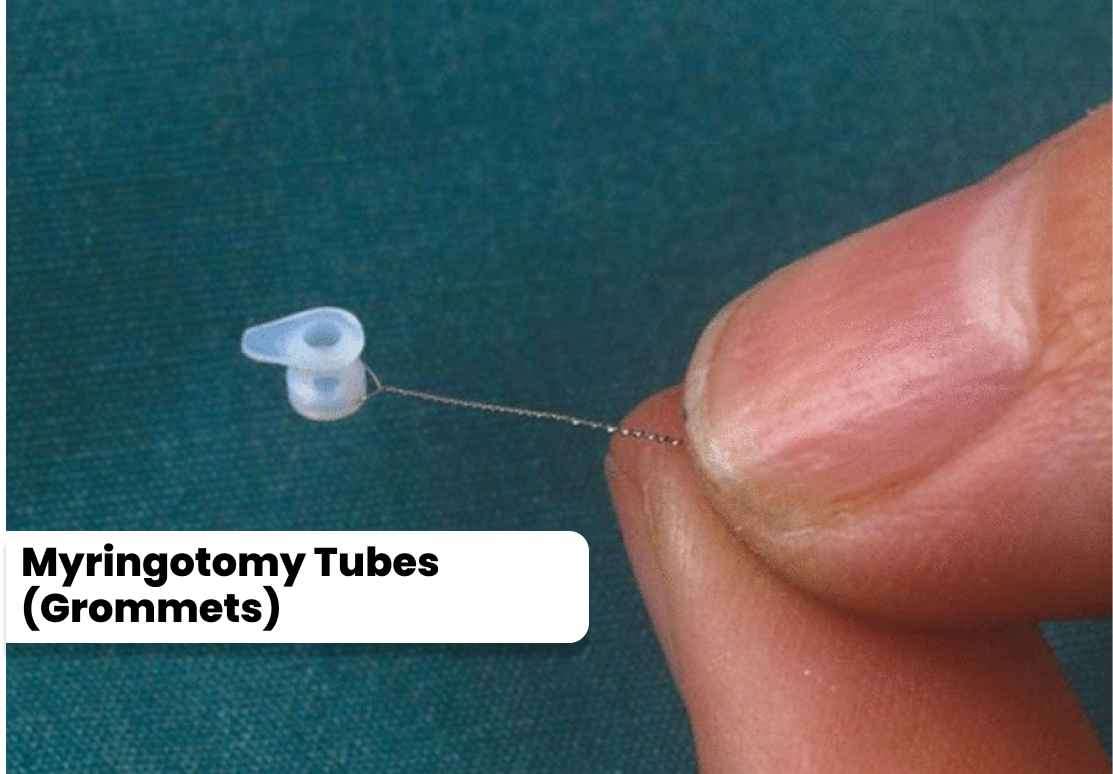 Myringotomy Surgery: Procedure and Grommet Insertion | DoctorsApp